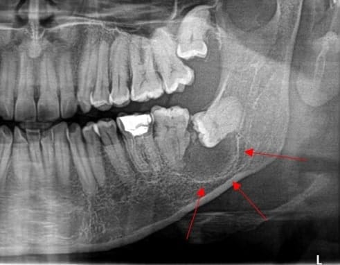 Enucleación de Quistes Maxilares - Cirugía Maxilofacial en Lima, Peru