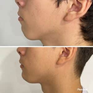 Perfilado Mandibular y Estética Facial - Cirugía Plástica en Lima, Peru