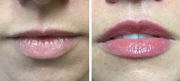 Lifting de Labio Superior para Labios Caídos - Cirugía en Peru