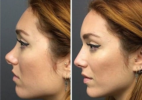 Rinoplastia líquida | Rinoplastia sin cirugía | Rinomodelación en Lima ...