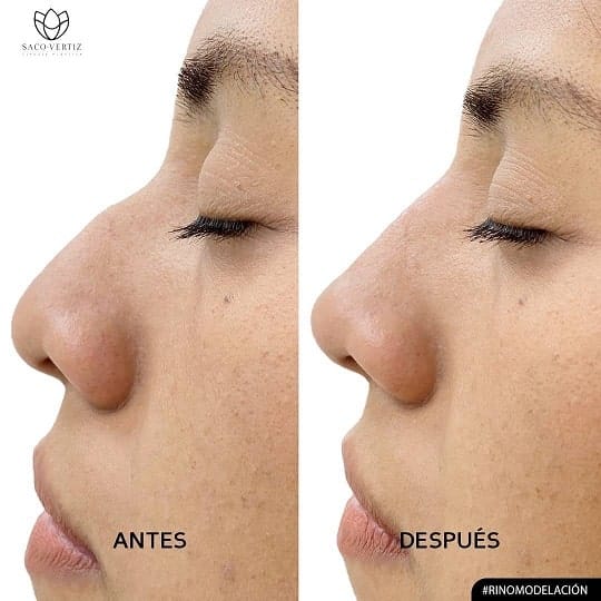 Rinoplastia en Lima Peru | Cirugía de Nariz - Precio y Procedimiento